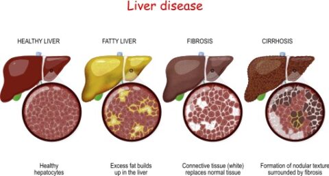 CRISPR Identifies Potential New Regulators of Fibrosis in Liver Cells